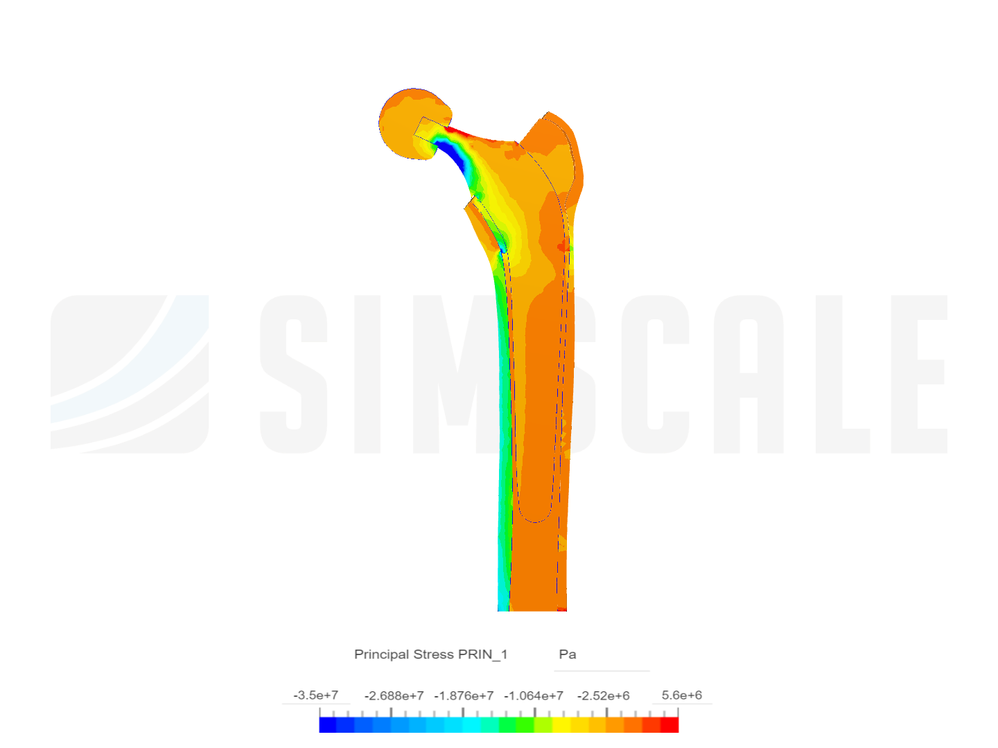 Biomaterials Hip implant mini project by jdelucia | SimScale