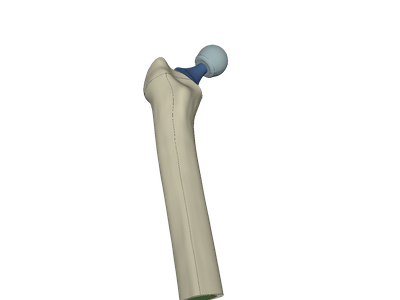 Biomedical Workshop: Hip Joint Prosthesis - Template by jousefm | SimScale