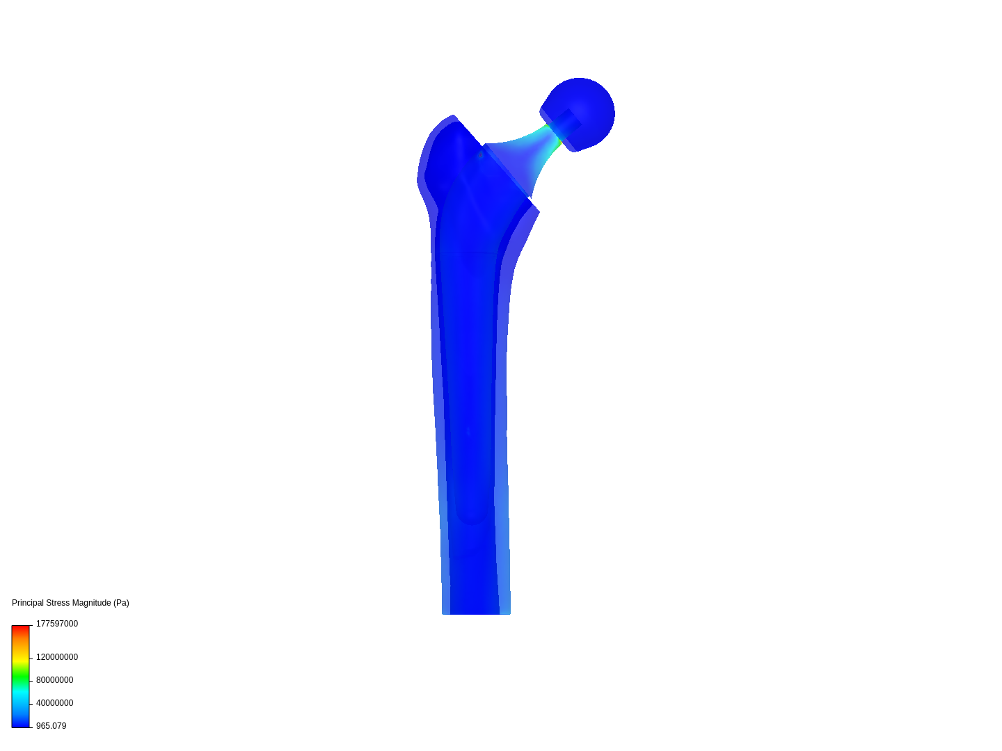 Hip Joint Prosthesis By Nihalmohammed79 Simscale 6858