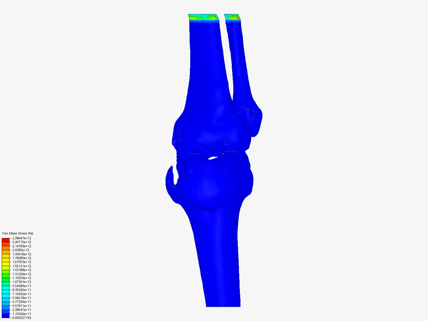Knee Joint - Copy by sindhuk9070_ss | SimScale